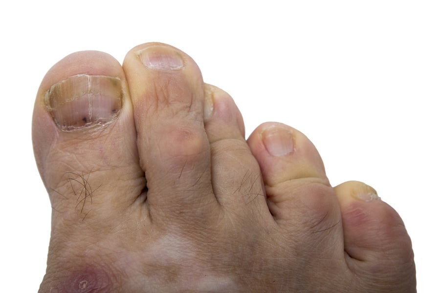 Toe Pain And Discolored Toenails toe-pain-and-discolored-toenails