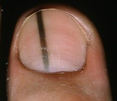Subungual Melanoma